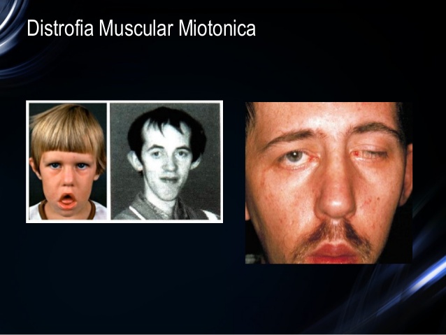 Servicio de noticias en salud Al Día – tratamiento para distrofia ...